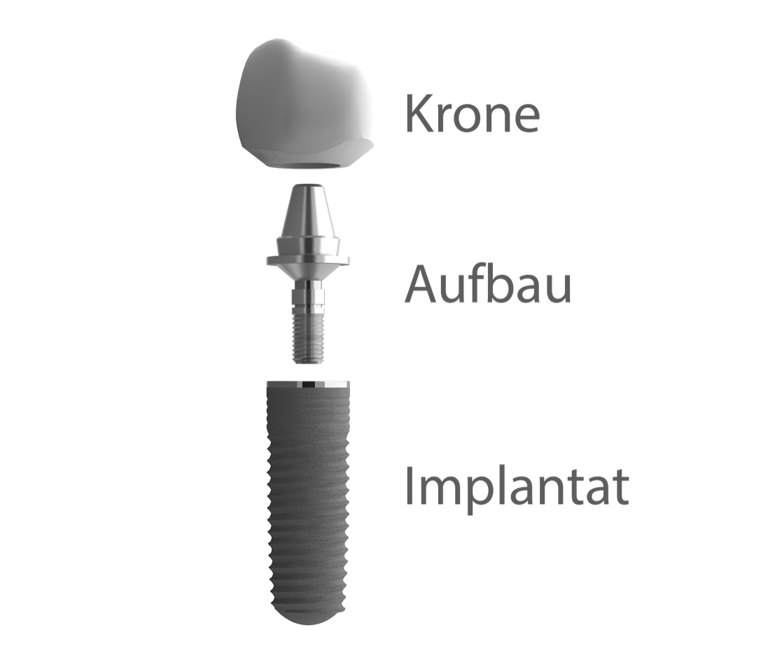 Implantate – Dentallabor Werner